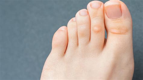 Corns Causes Symptoms Treatment Gesund Bund De