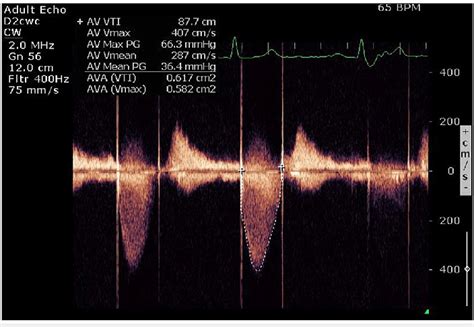 Repeat Tte Post First Cycle Of Tpa Therapy Showed A Mean Transvalvular Download Scientific