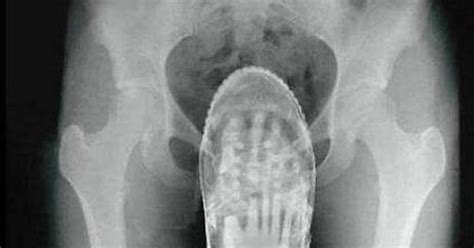 Some Wtf X Rays Album On Imgur