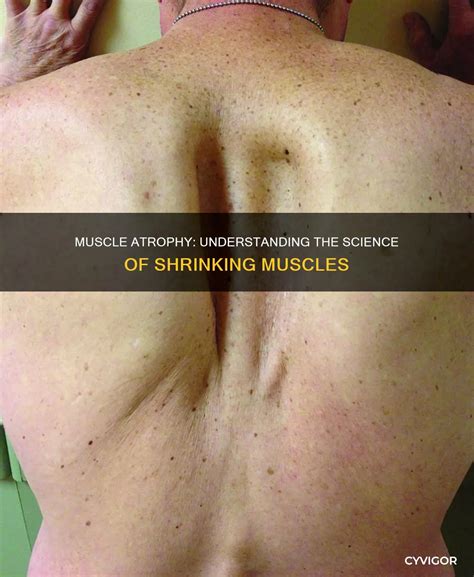 Muscle Atrophy Understanding The Science Of Shrinking Muscles Cyvigor