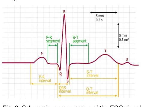 Figure 3 From Blind Source Separation Of Fetal Ecg Using Fast Independent Component Analysis And