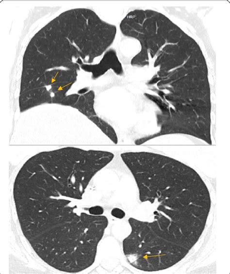 High Resolution Chest Computed Tomography Showing Bilateral Solid Download Scientific Diagram
