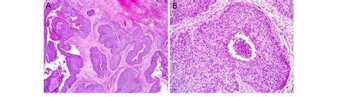 Nonkeratinizing Squamous Cell Carcinoma Of The Sinonasal Tract A Low