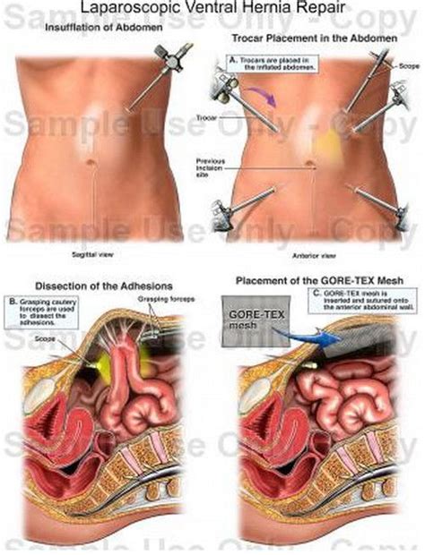 Laparoscopic Ventral Hernia Repair Artofit