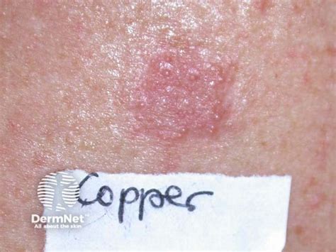 Patch Test Images