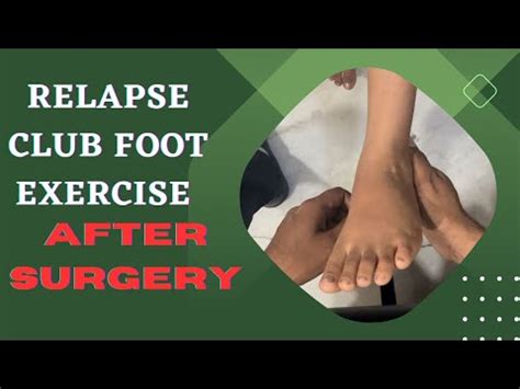Relapse Club Foot Exercise After Tandon Transfer Surgery Ll Relapse