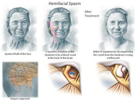 Hemifacial Spasm Medizzy