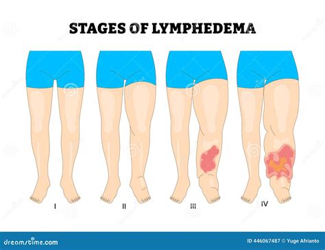 Lymphedema Stages Lymphatic System Dysfunction Disease Swollen Legs