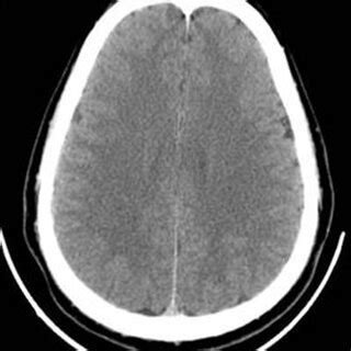 Computed Tomography Image Of The Brain Showing Mild Diffuse Cerebral Edema Download Scientific