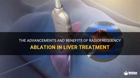 The Advancements And Benefits Of Radiofrequency Ablation In Liver