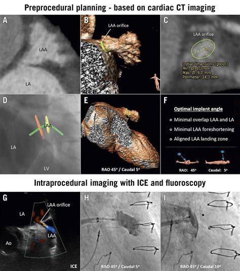 Percutaneous Left Atrial Appendage Closure In A Surgically Ligated Left Atrial Appendage