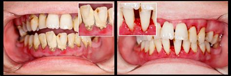 Does Diabetes Affect Teeth And Gums Diabeteswalls
