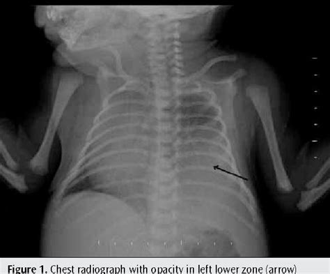 Figure 1 From Extralobar Pulmonary Sequestration In A Neonate Semantic Scholar