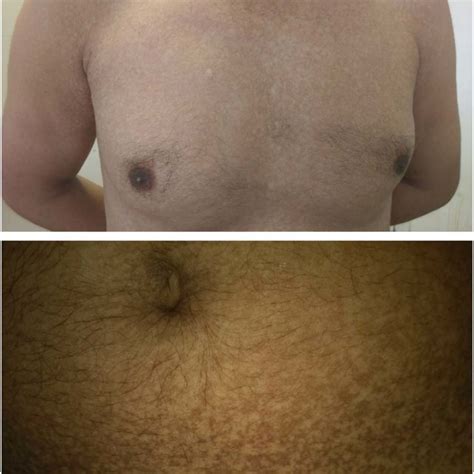 Reticulate Hyperpigmentation On Palms Download Scientific Diagram