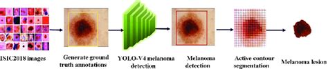 Melanoma Lesion Segmentation Using Melanoma Localization And