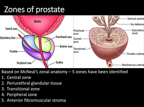 Benign Prostatic Hyperplasia Pptx
