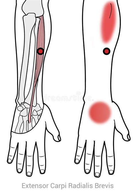 Extensor Carpi Radialis Brevis Displaying Elbow And Top Of Hand
