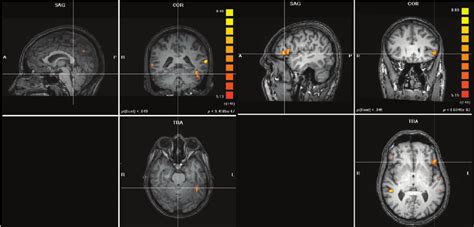 Example Of Rois In A Single Subject Regions With Significantly Greater