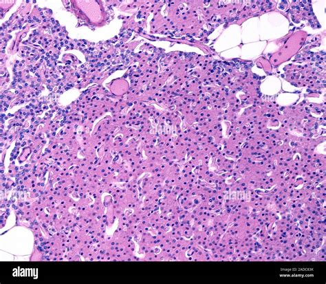 Parathyroid Gland Chief Cells Histology Primary Hyperparathyroidism