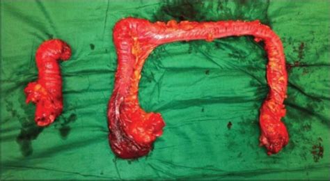 Adult Rectosigmoid Junction Intussusception Presenting With Rectal Prolapse Pmc