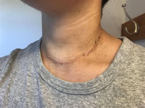 Total Thyroidectomy And Left Neck Dissection Scar 5 Weeks After Surgery R Thyroidcancer