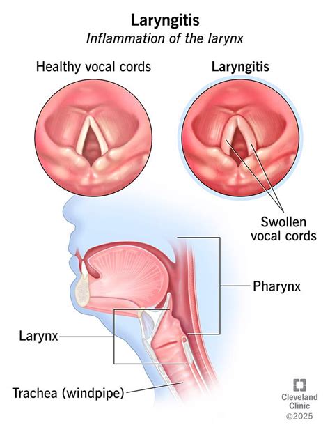 Laryngitis Symptoms Causes And Treatment