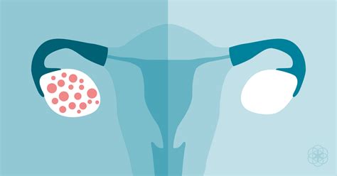 Pcos 101 Symptoms Diagnosis Treatment And More