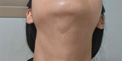 병원질문 턱 밑에 저 불룩한 강남언니 1등 성형수술and피부시술 정보앱