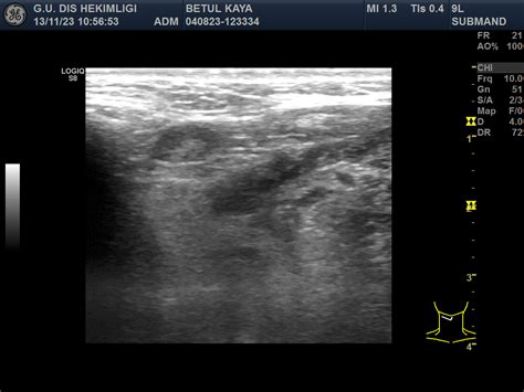 Lymph Node Instance Segmentation Dataset By Gaziantep University