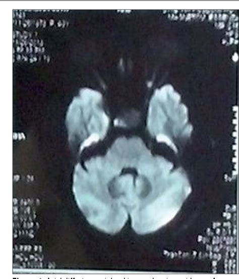 Figure 4 From Suprasellar Arachnoid Cyst With Spontaneous Intracystic Hemorrhage A Rare