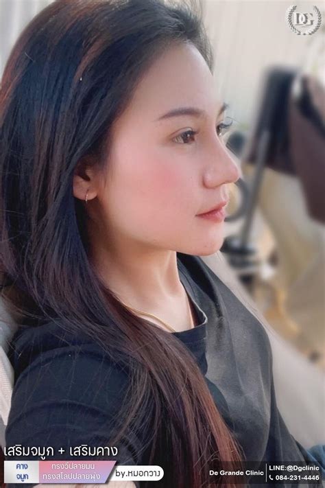 🔅 สวยแซ่บ แบบแพ็คคู่ กับเคสเสริมคาง เสริมจมูก By คุณหมอกวาง 👩‍⚕️ 🛑กับโปรโมชั่นพิเศษ เสริมคาง