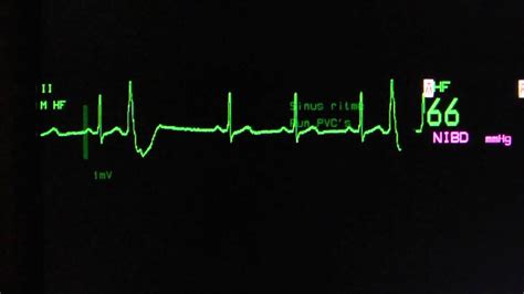 Heart Monitors Arrhythmia