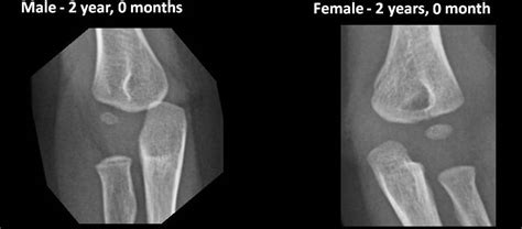 Ossification Centers Elbow