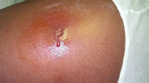 Bug Bite Vs Staph Infection