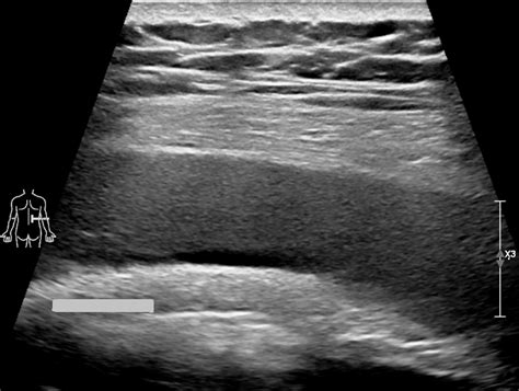 Scapulothoracic Bursitis Diagnosis At Greta Pickard Blog