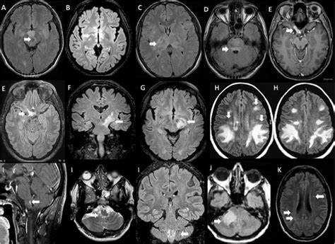 Frequency Of Brain Mri Abnormalities In Neuromyelitis Optica Spectrum Disorder At Presentation