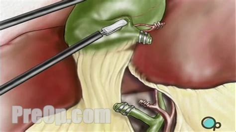 Patient Education Gallbladder Removal Laparoscopic Surgery Preop® Youtube