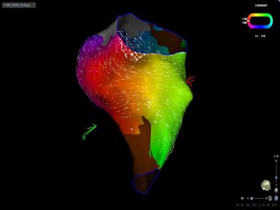 The History Of Atrial Flutter Electrophysiology From Entrainment To Ablation Cardiac
