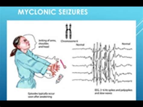Myoclonic Seizures Juvenile Myoclonic Epilepsy Definition Symptoms