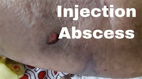 Intramuscular Injection Abscess Youtube