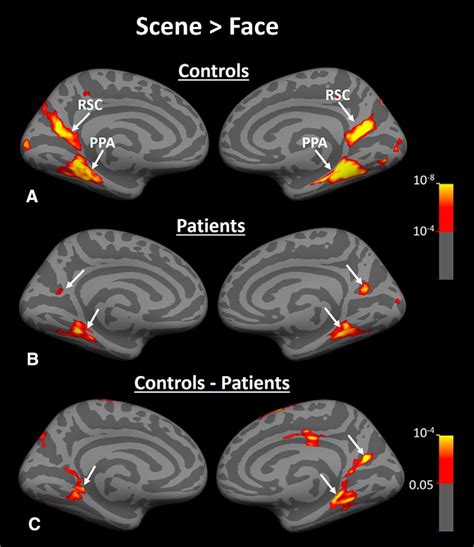 Impact Of Visual Corticostriatal Loop Disruption On Neural Processing Within The Parahippocampal