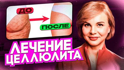 Как Избавиться От ЦЕЛЛЮЛИТА Навсегда 90 женщин этого не знают Youtube