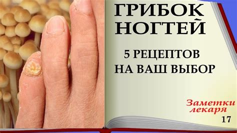 как лечить грибок ногтей на ногах в домашних условиях видео Uniformcustomize