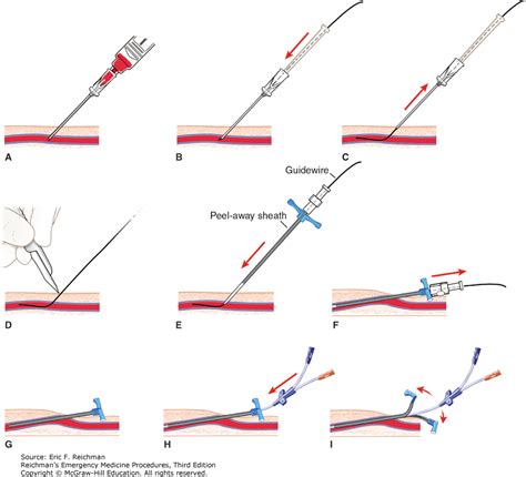 Picc Line Removal Charting Sample Peripheral Inserted Central Catheter Picc Lines