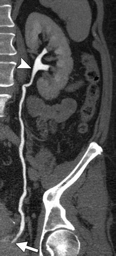 Male Ureter Ct Scan