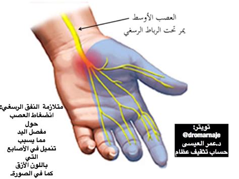 من الشائع كثيرًا في عيادة العظام وبخاصةٍ لدى النساء ومرضى السكر