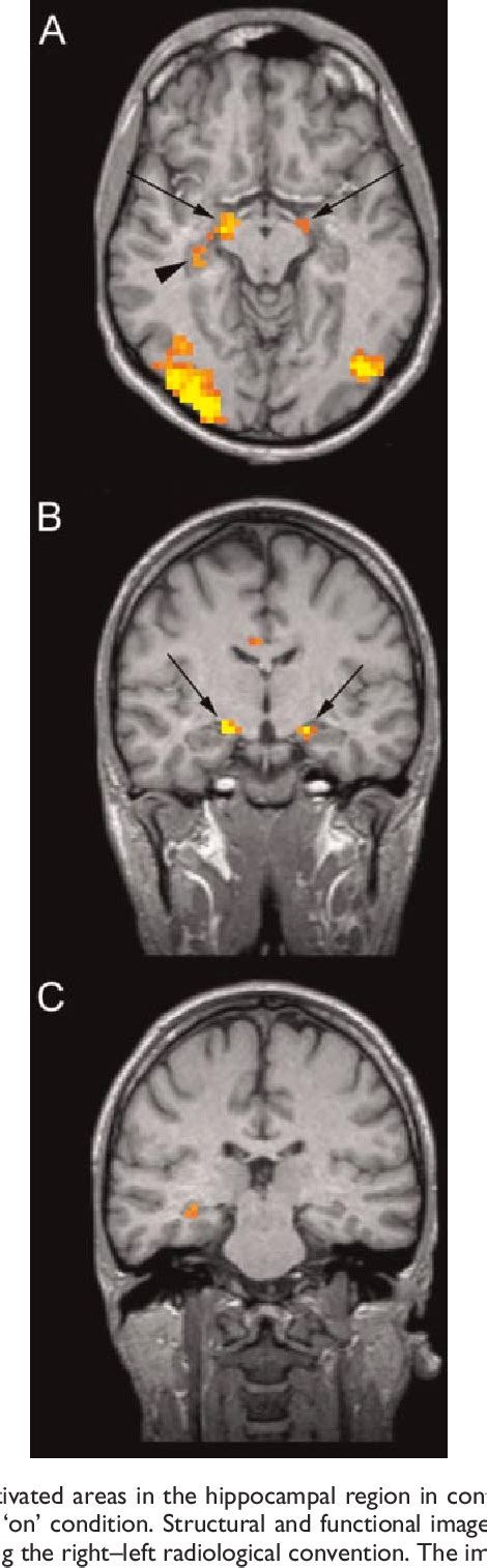 Figure 3 From Functional Mri Study Of Diencephalic Amnesia In Wernicke