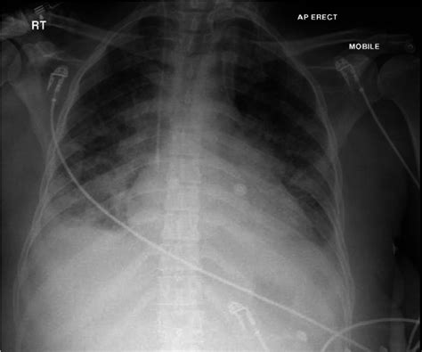 Chest X Ray Showing Bilateral Diffuse Infiltrates Download