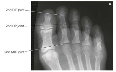 Lower Extremity X Rays Flashcards Quizlet