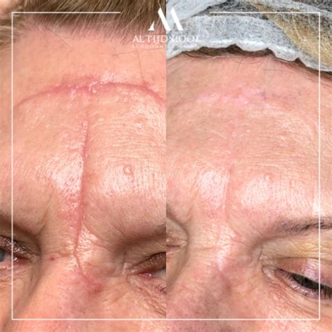 Litteken Behandeling In Maarssen Altijdmooi Schoonheidssalon